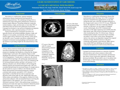 "A Rare Manifestation of Sarcoidosis: A Case of Laryngeal Infiltration ...